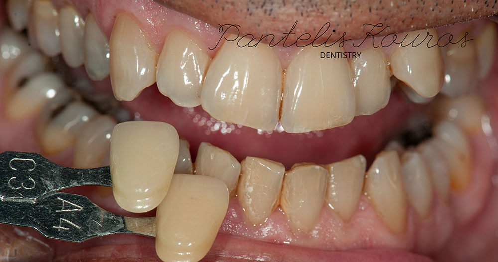 Αισθητική Οδοντιατρική - Dental Services